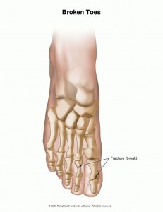 Broken Toe – Symptoms, Diagnosis, Treatment and Pictures